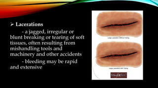 Wounds | PPTX