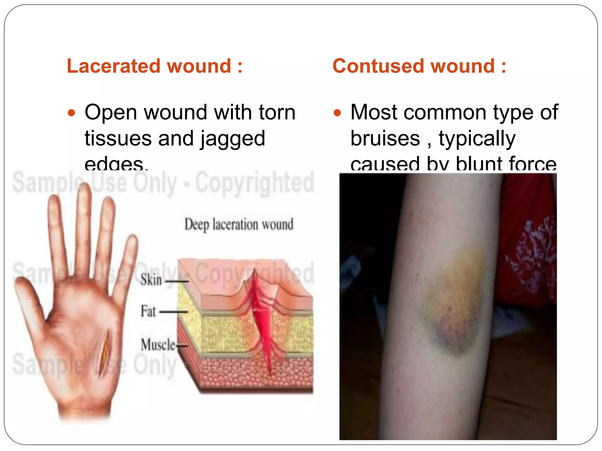 Wounds | PPTX