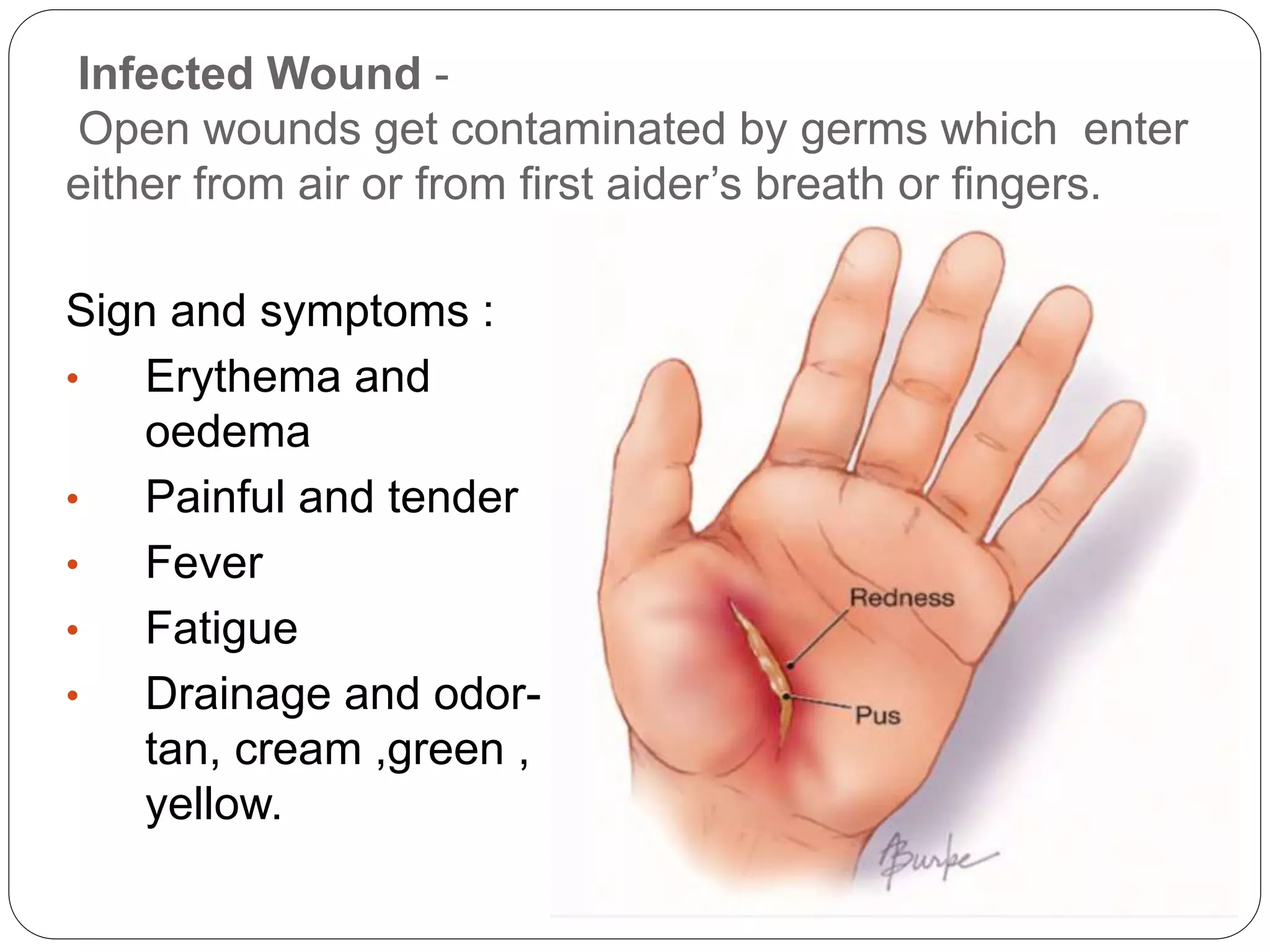 Wounds | PPTX