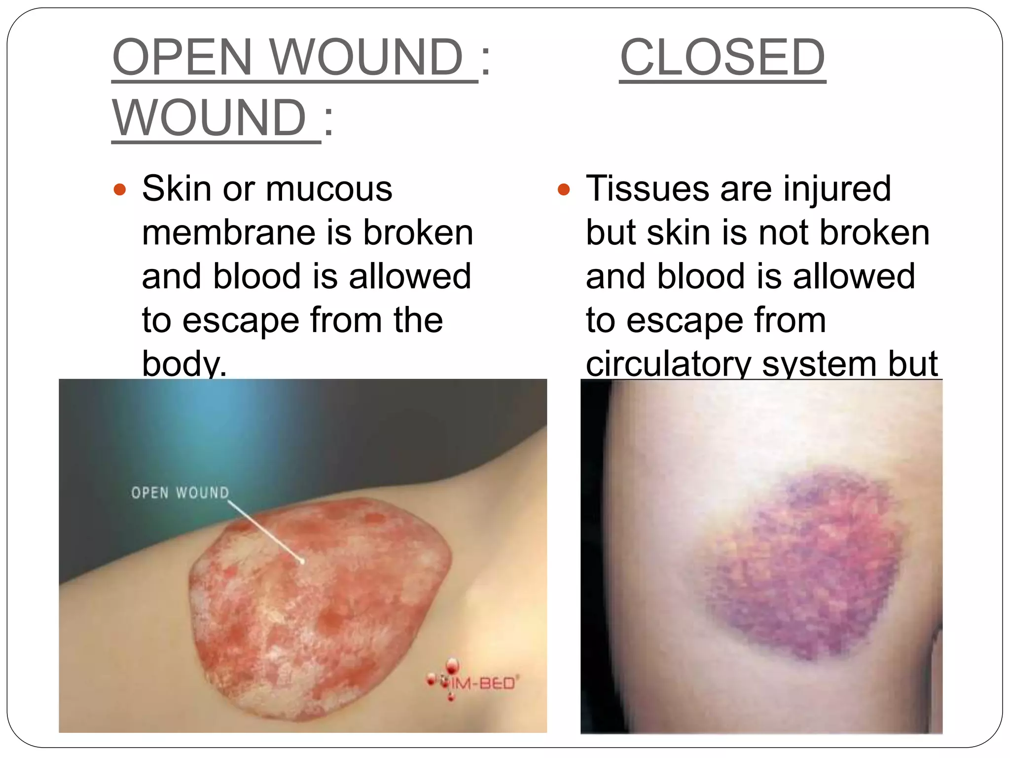 Wounds | PPTX