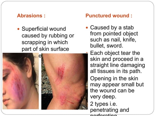 Wounds | PPTX | First Aid | Injuries