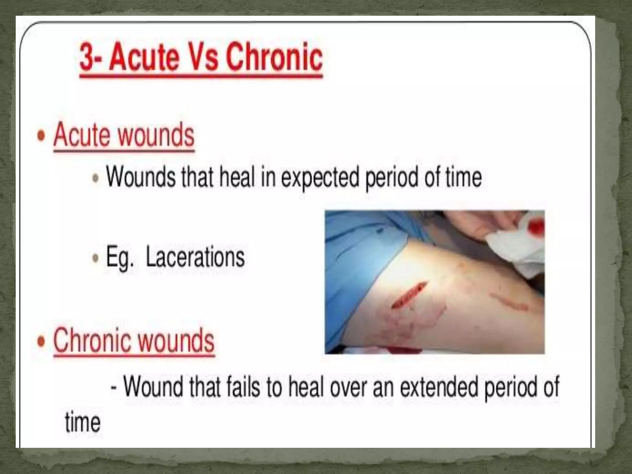 Wounds | PPTX