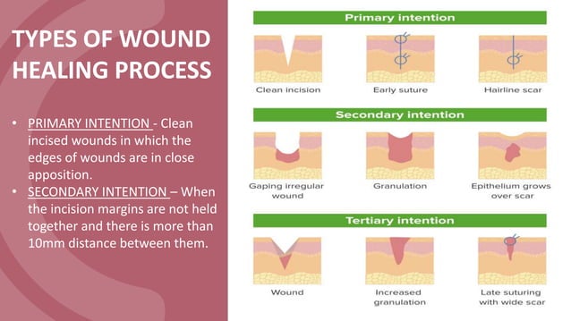 WOUNDS.pptx | Death, Injury, or Military Conflict | Sensitive Topics