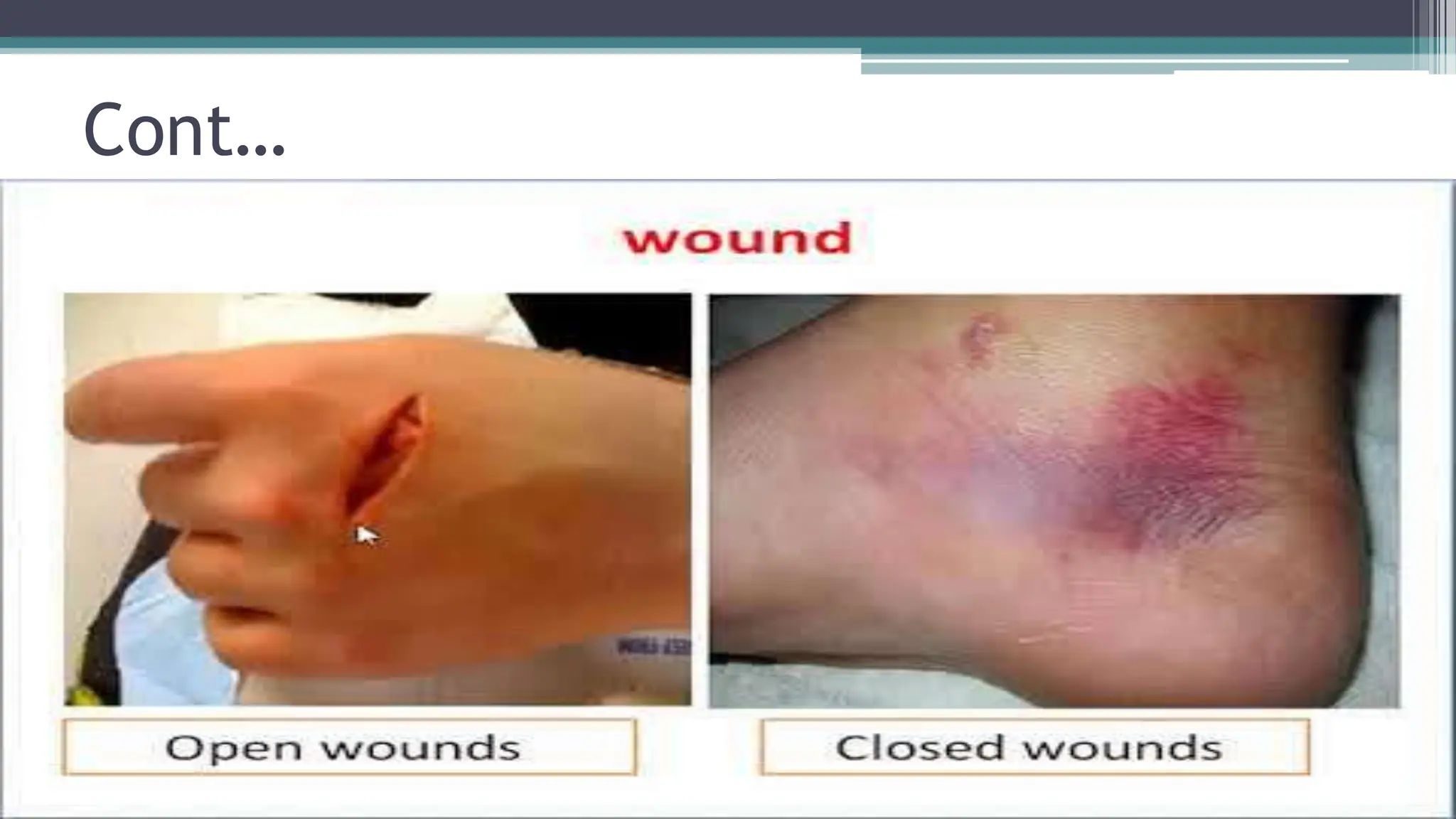 WOUNDS, wound healing process types of wounds.pptx | Death, Injury, or Military Conflict ...