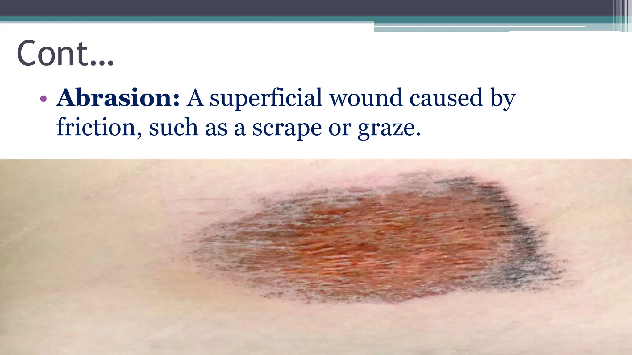 WOUNDS, wound healing process types of wounds.pptx | Death, Injury, or ...