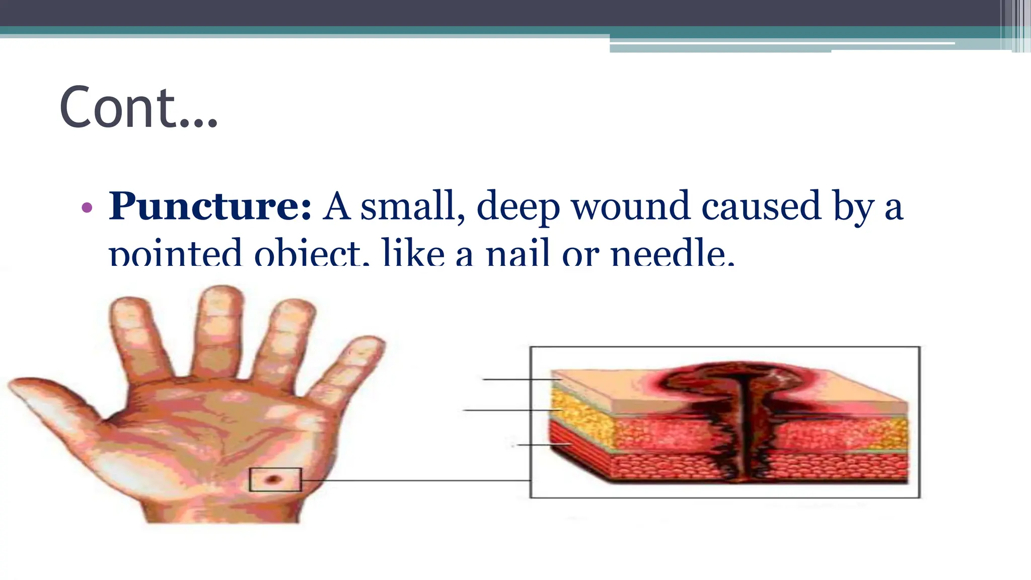WOUNDS, wound healing process types of wounds.pptx