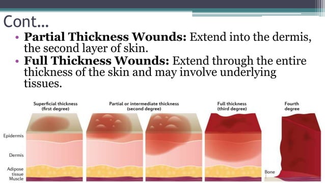 WOUNDS, wound healing process types of wounds.pptx | Death, Injury, or ...