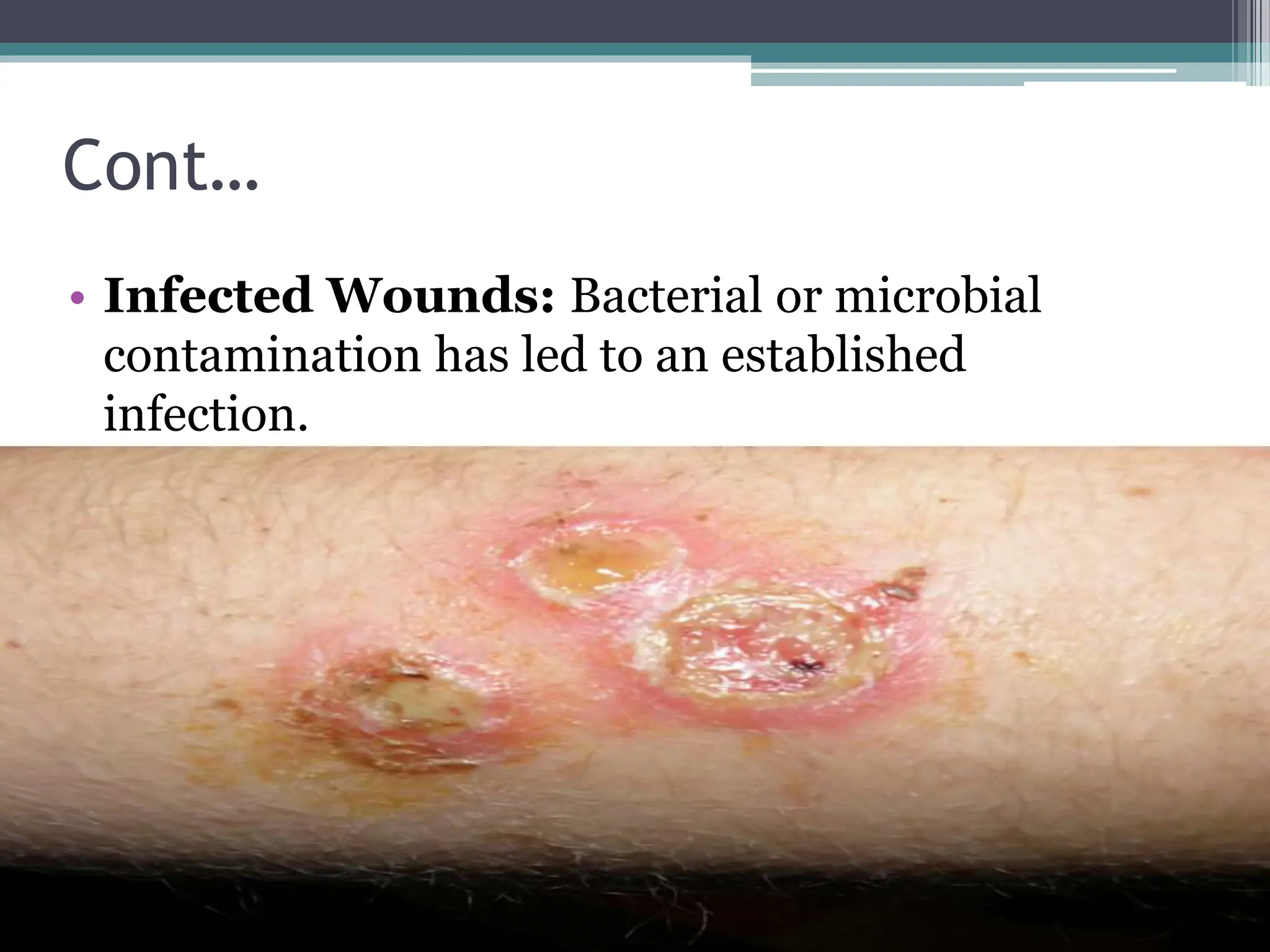 Wounds, types of wounds, wound healing process, complications of wound, | PPTX