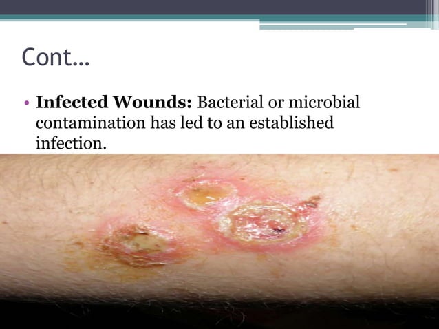 Wounds, types of wounds, wound healing process, complications of wound ...