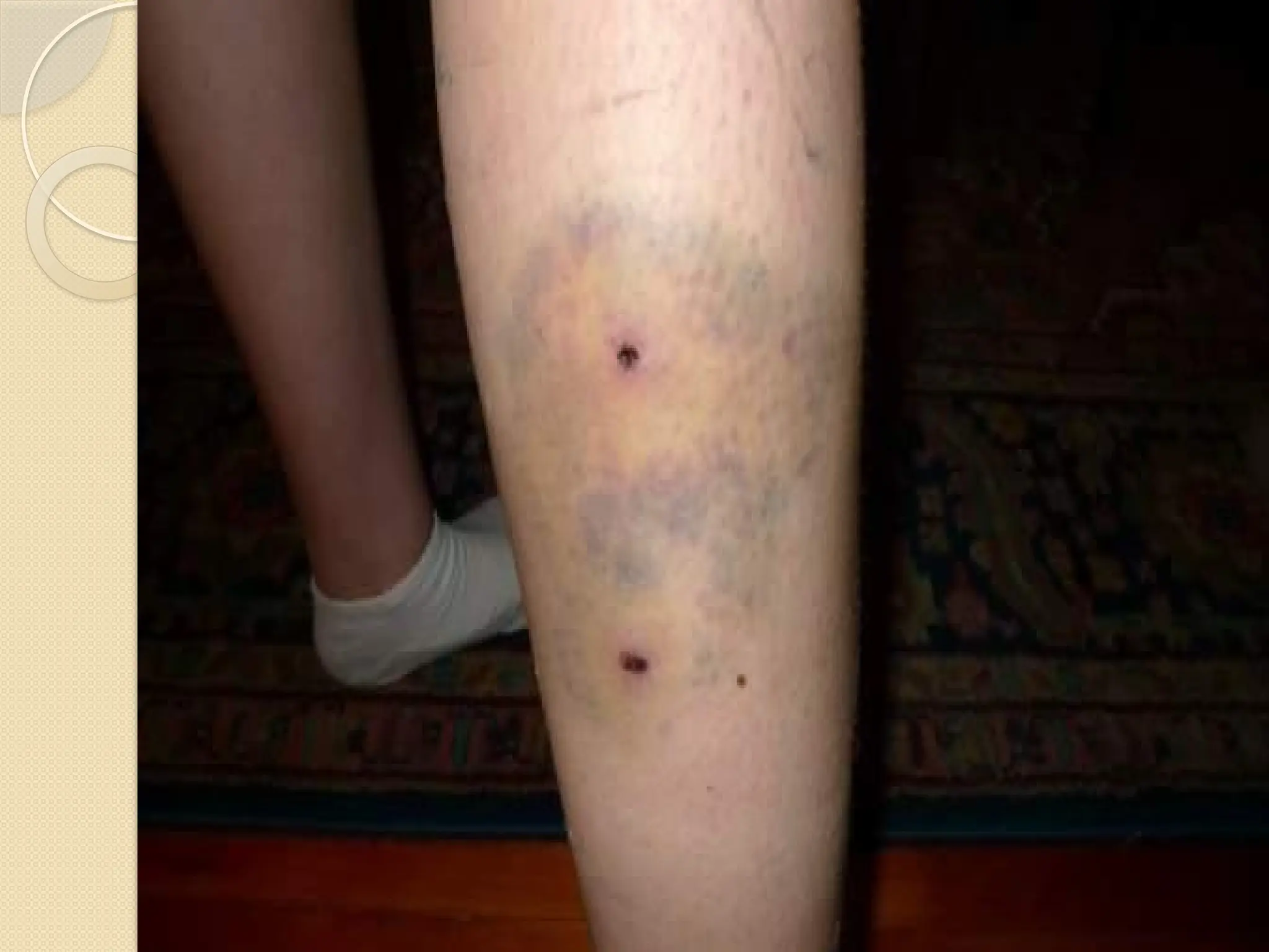 types of wounds mapeh - health quater 3 | PPTX