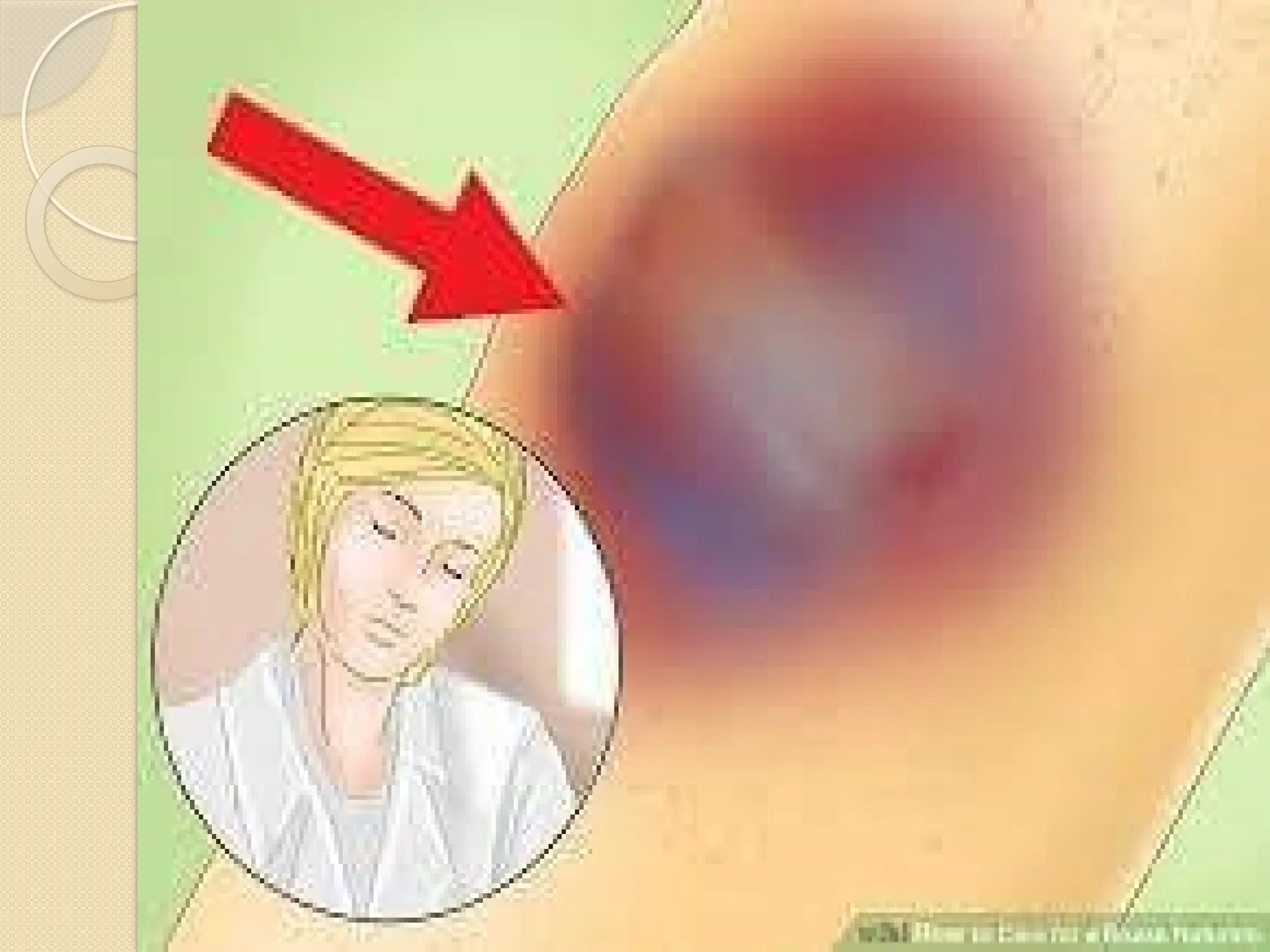 types of wounds mapeh - health quater 3 | PPTX