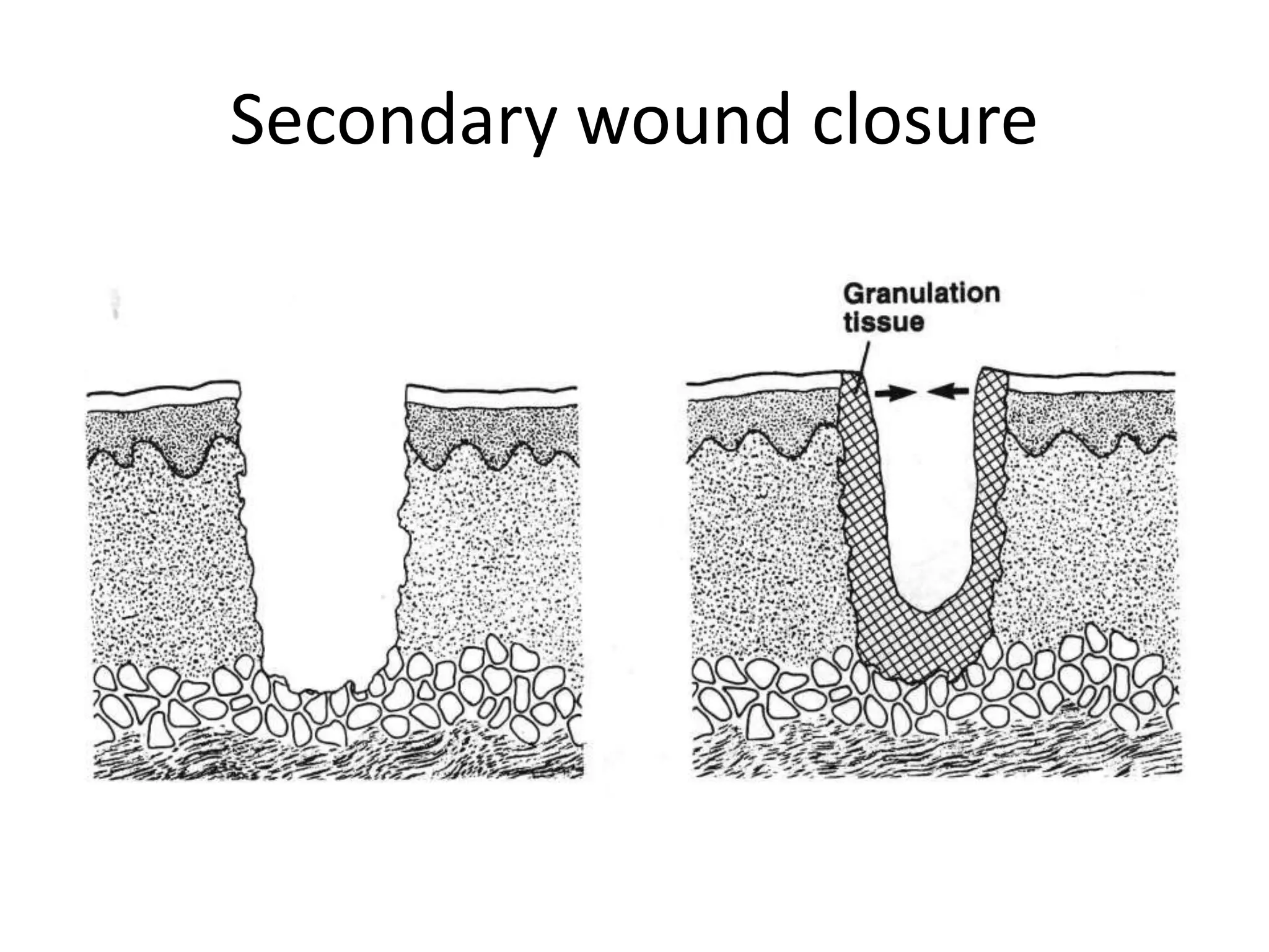 Wounds And wound dressing (Advanced Nursing I) .pptx