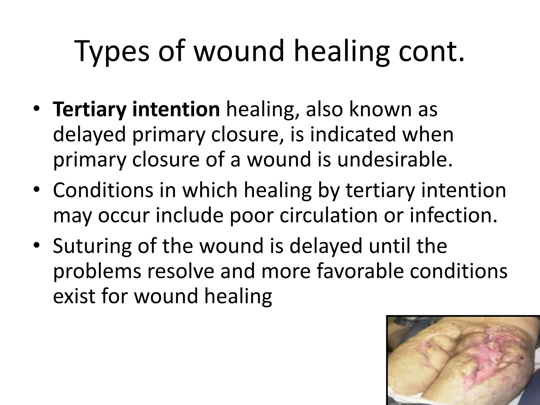 Wounds And wound dressing (Advanced Nursing I) .pptx