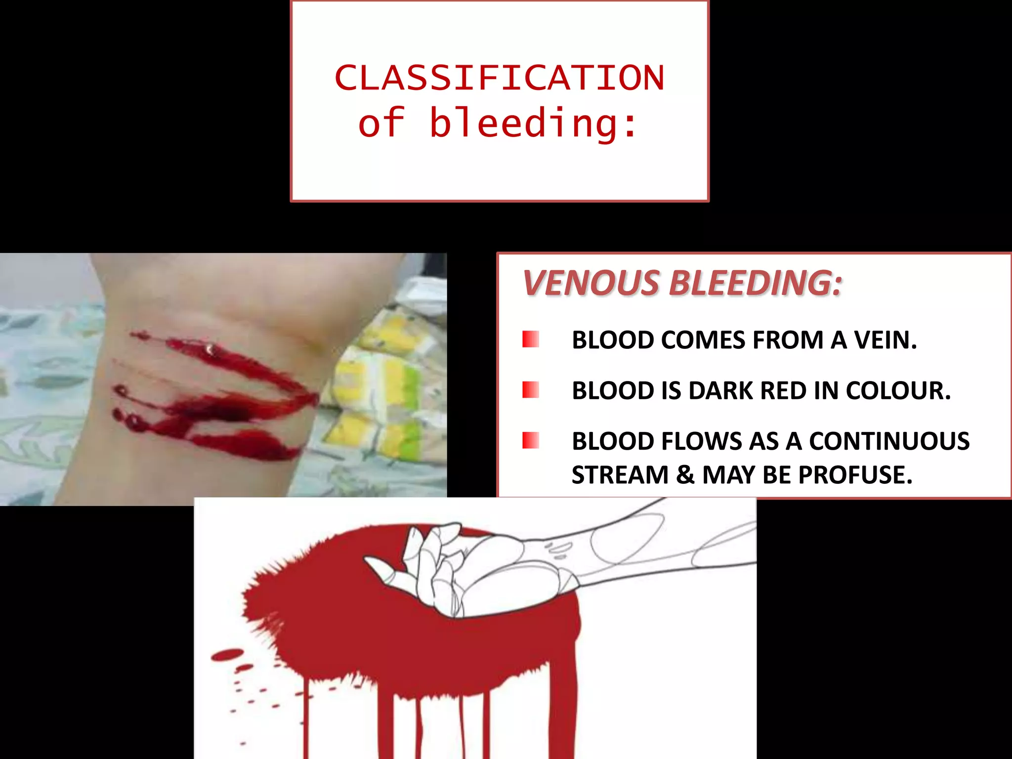 Wounds and bleeding | PPTX