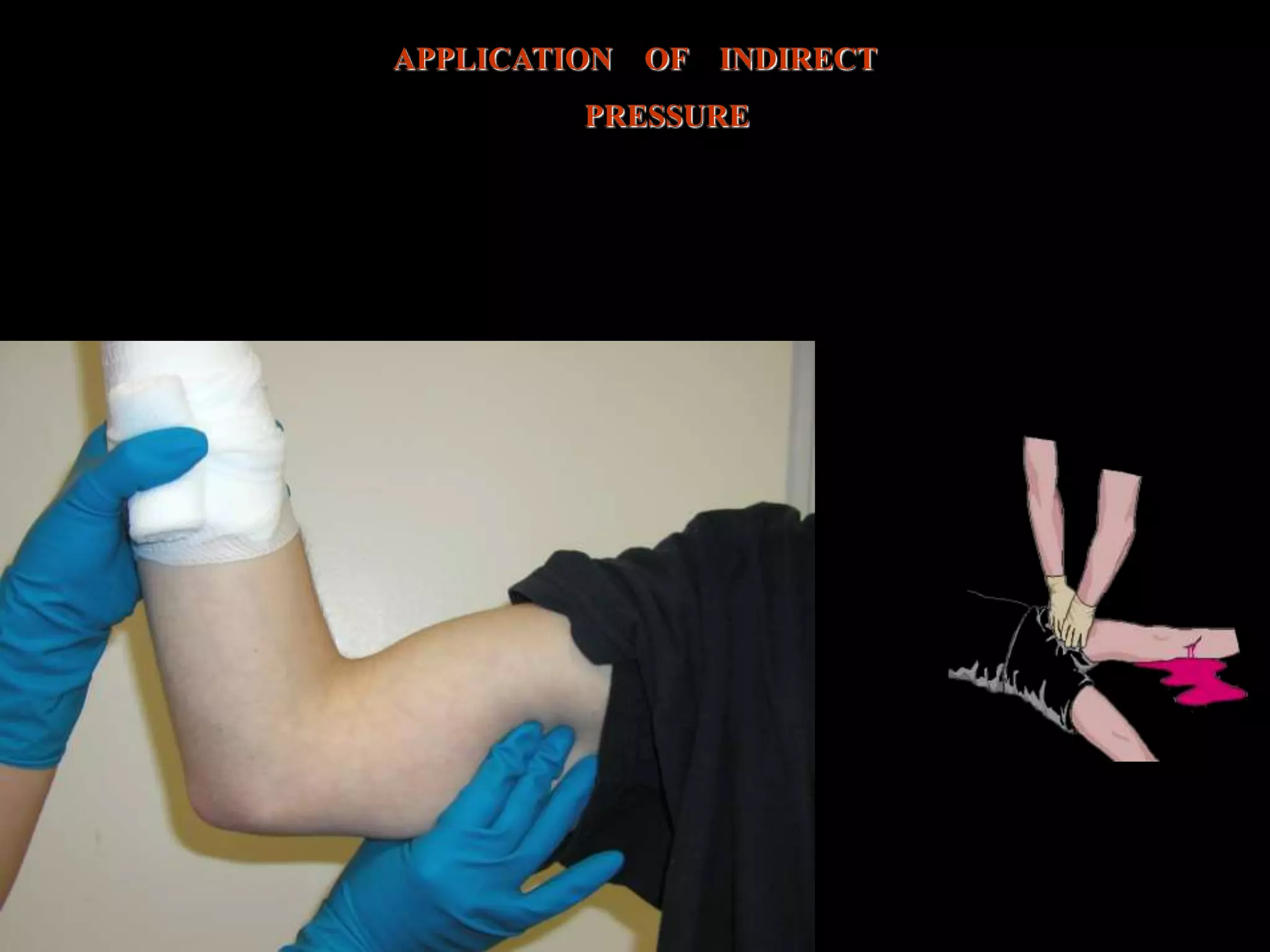 Wounds and bleeding | PPTX