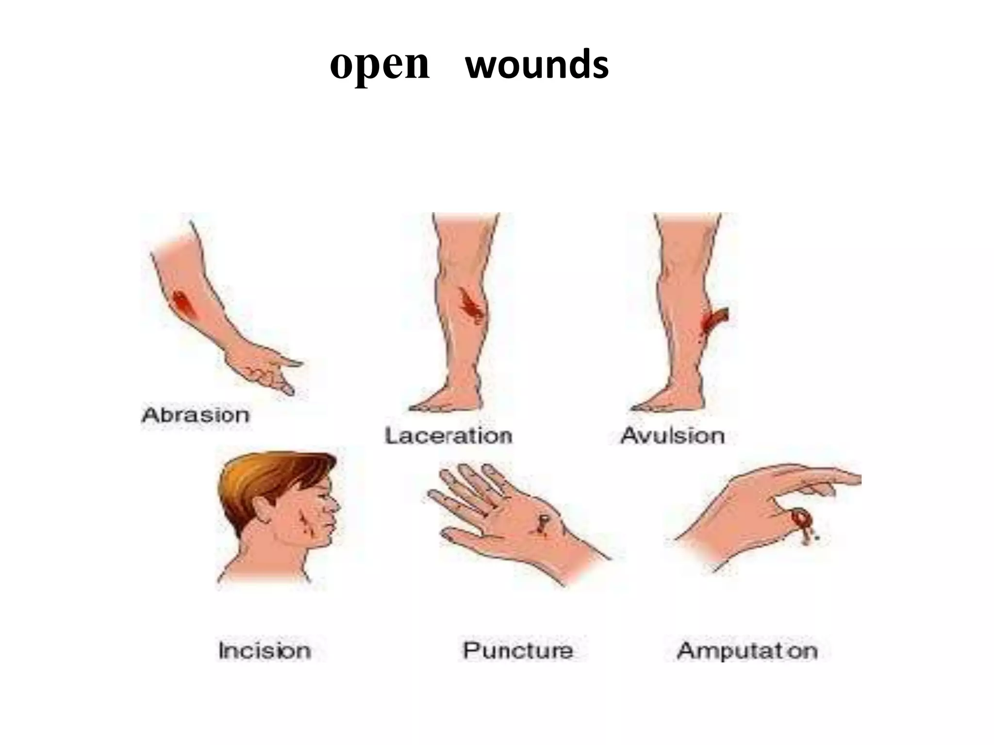Wounds and bleeding | PPTX