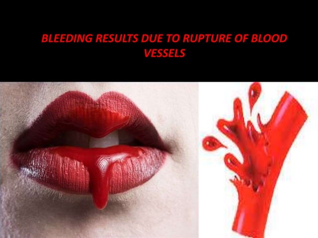 Wounds and bleeding | PPT