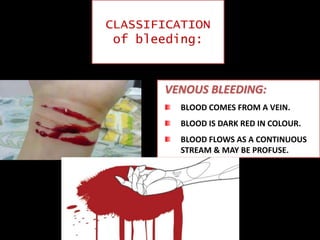 Wounds and bleeding | PPTX