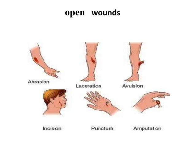 Wounds and bleeding