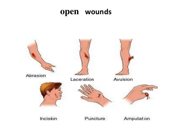 Wounds and bleeding