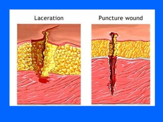 Wounds and burns | PPT