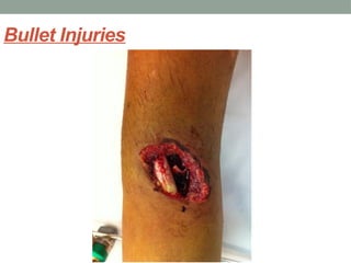 WOUNDS AND THEIR MANAGEMENT techniques reqiured for saving life.pptx