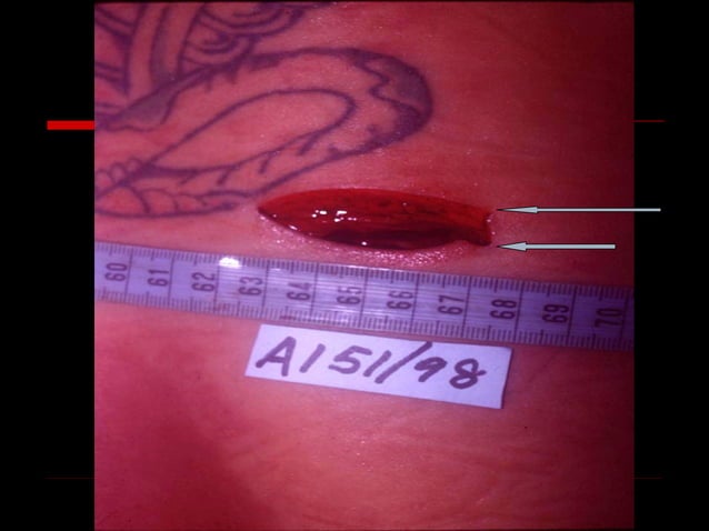 wounds_and_their_medico-legal_importance.ppt