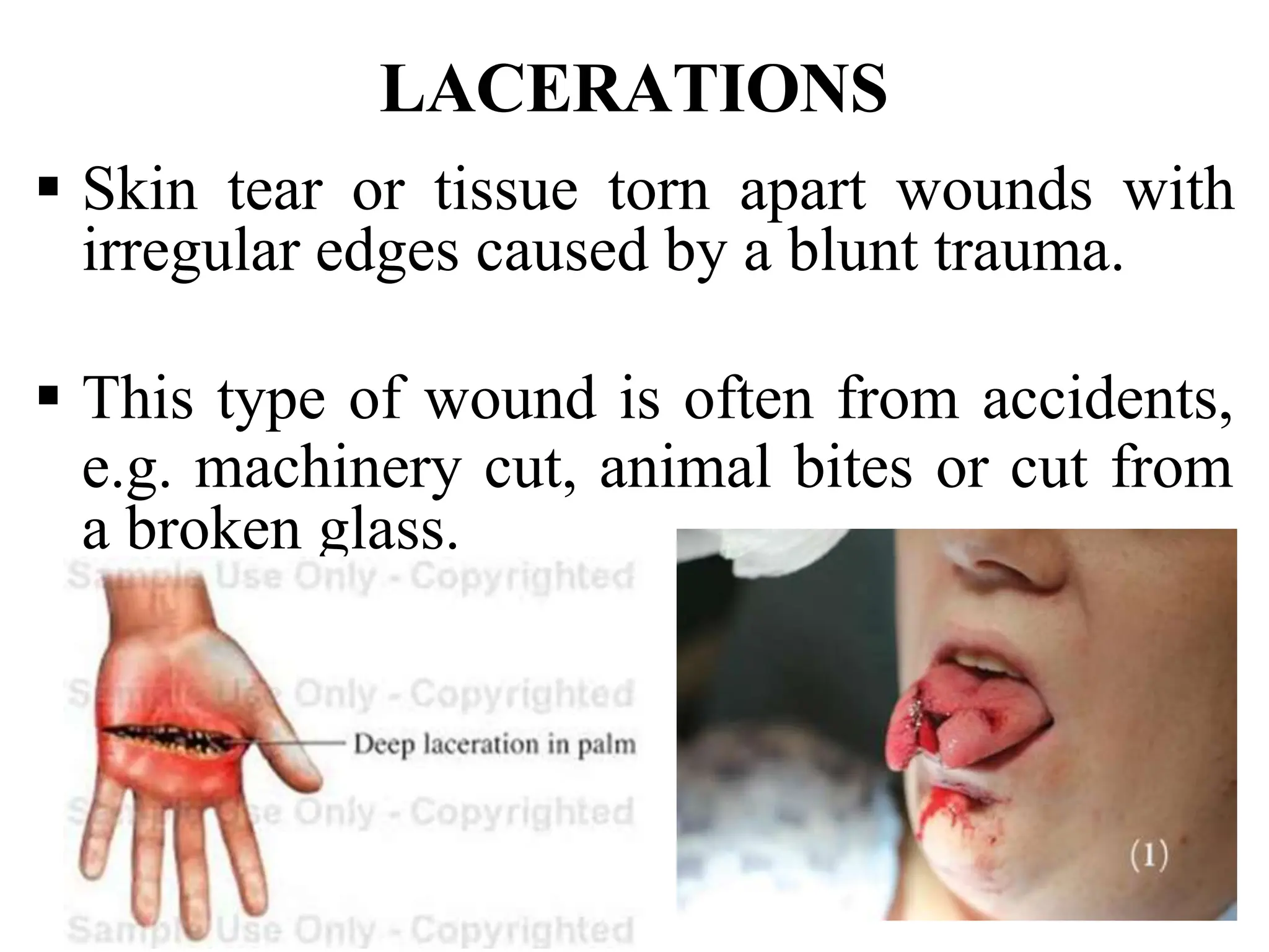 WOUNDS AND ULCERS-1.pptx