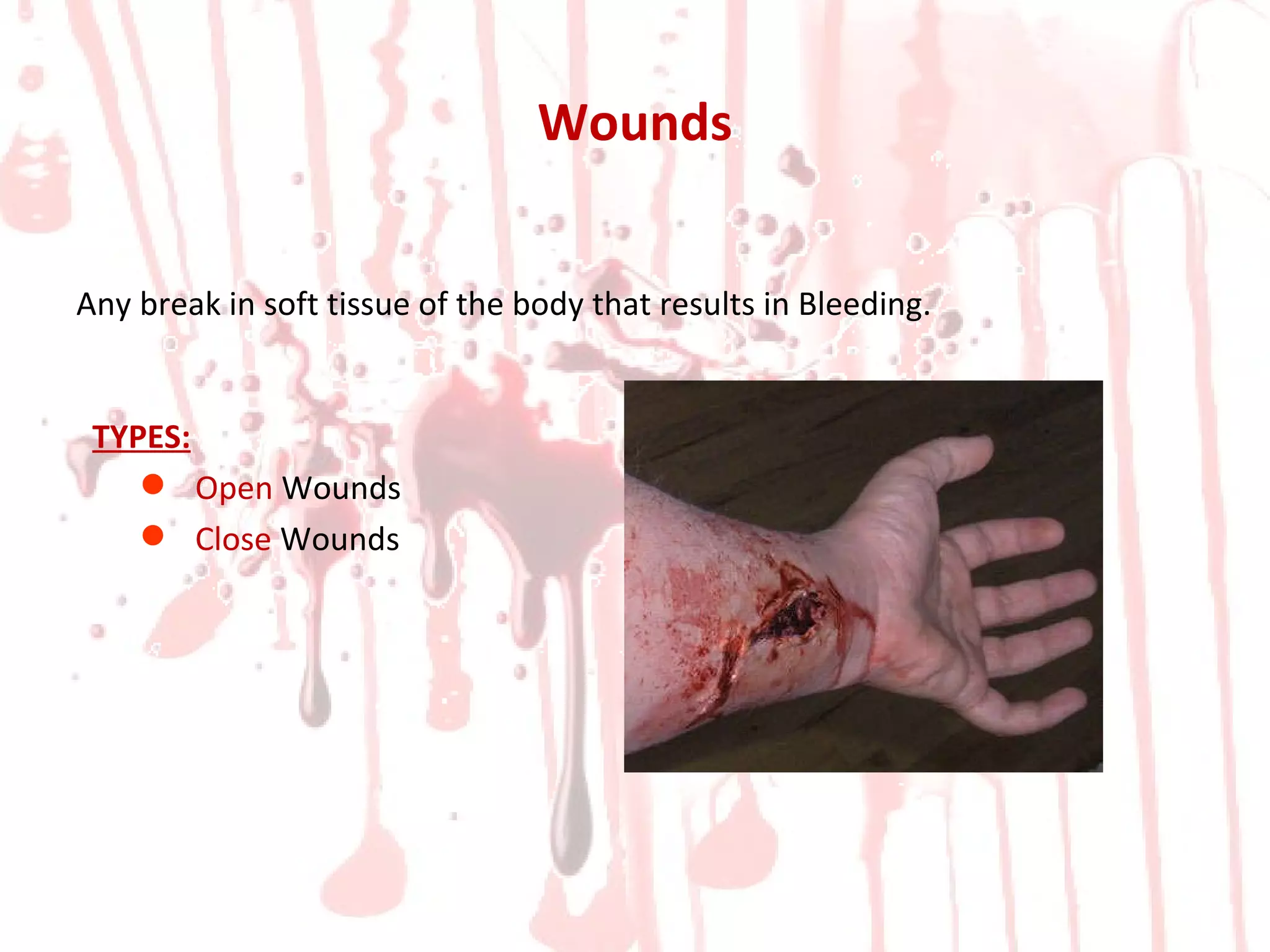 Wounds and Bleeding | PPT