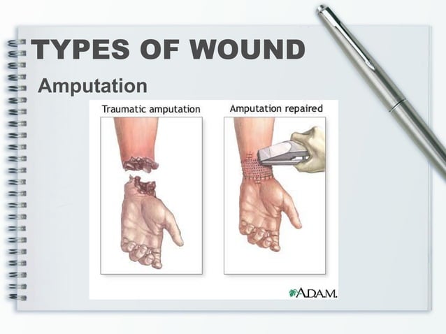 Wounds & bleeding_slides | PPT | First Aid | Injuries