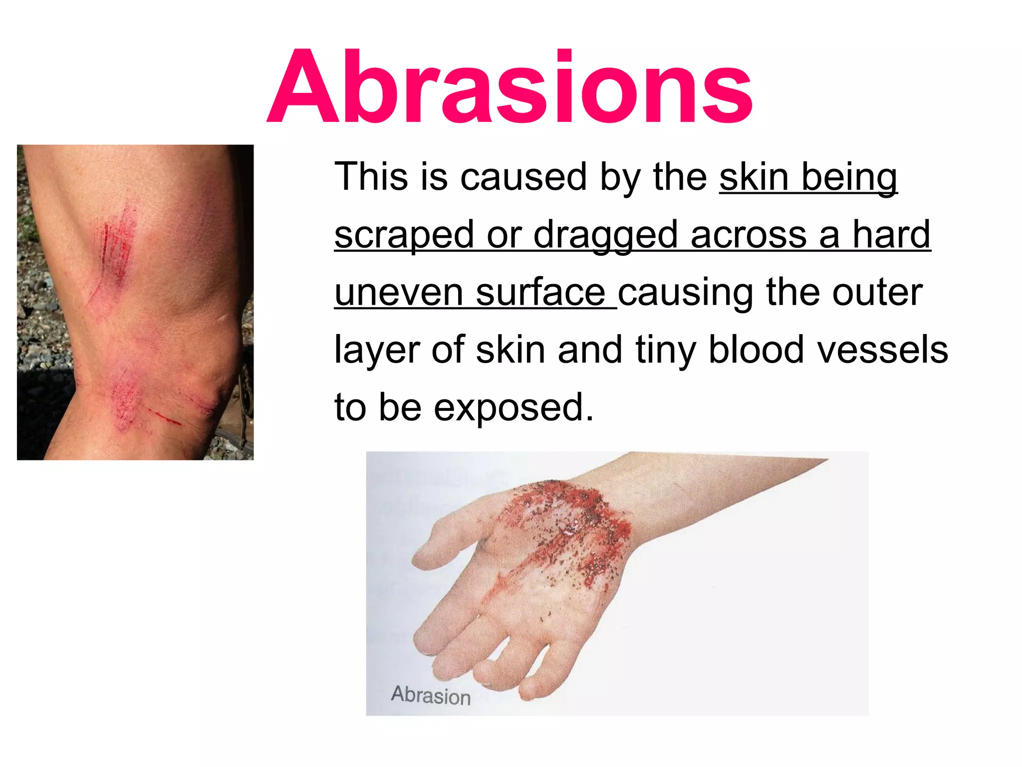 Wounds | PPT