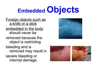 Wounds | PPT | First Aid | Injuries