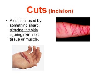 Wounds | PPT | First Aid | Injuries