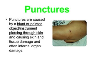 Wounds | PPT | First Aid | Injuries