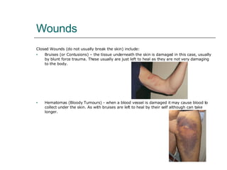 Wounds | PPT