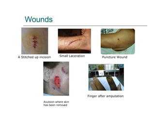 Wounds | PPT