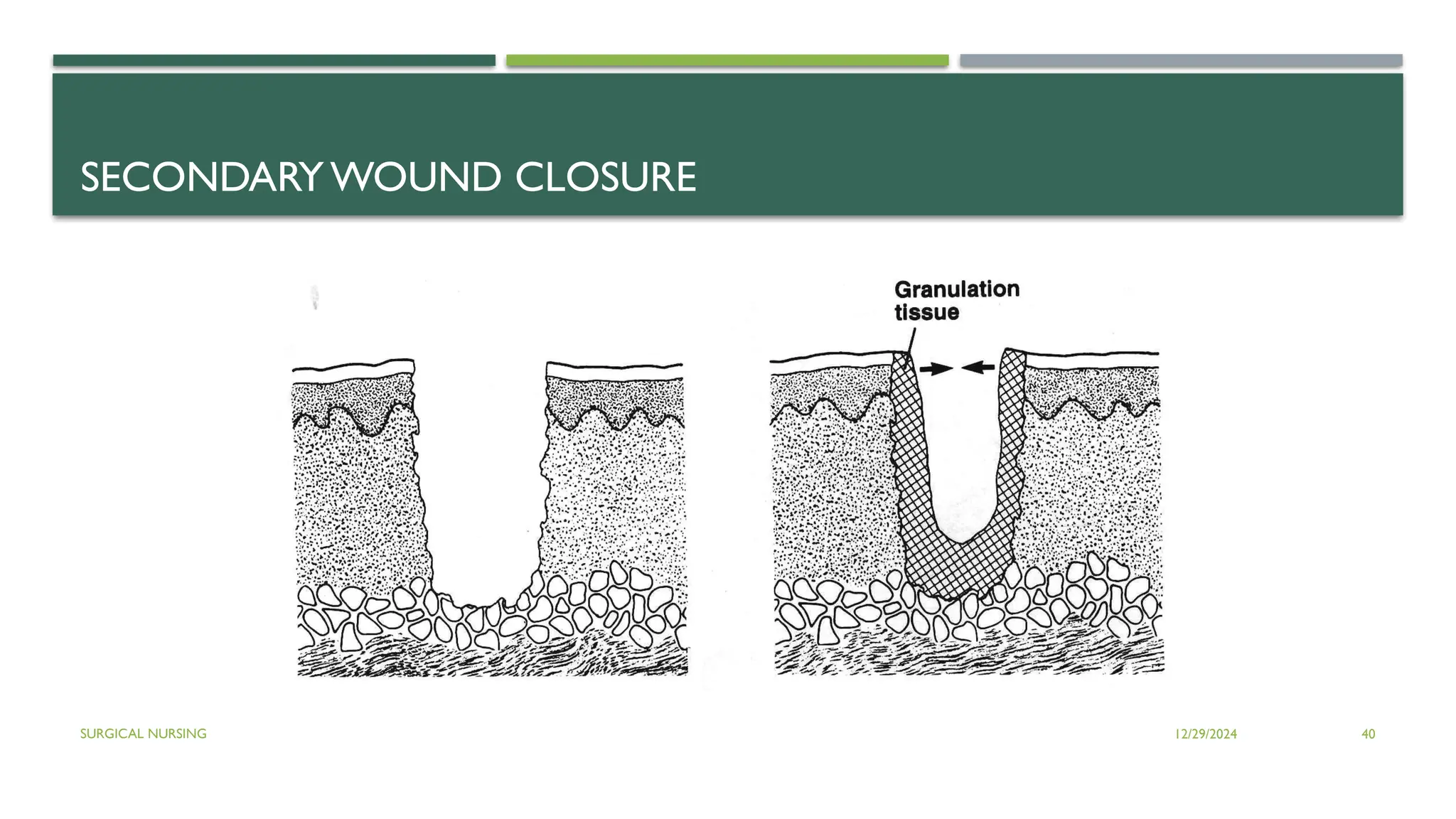 wound ; cause ,classification , healing phases ,pressure ulcer , wound ...