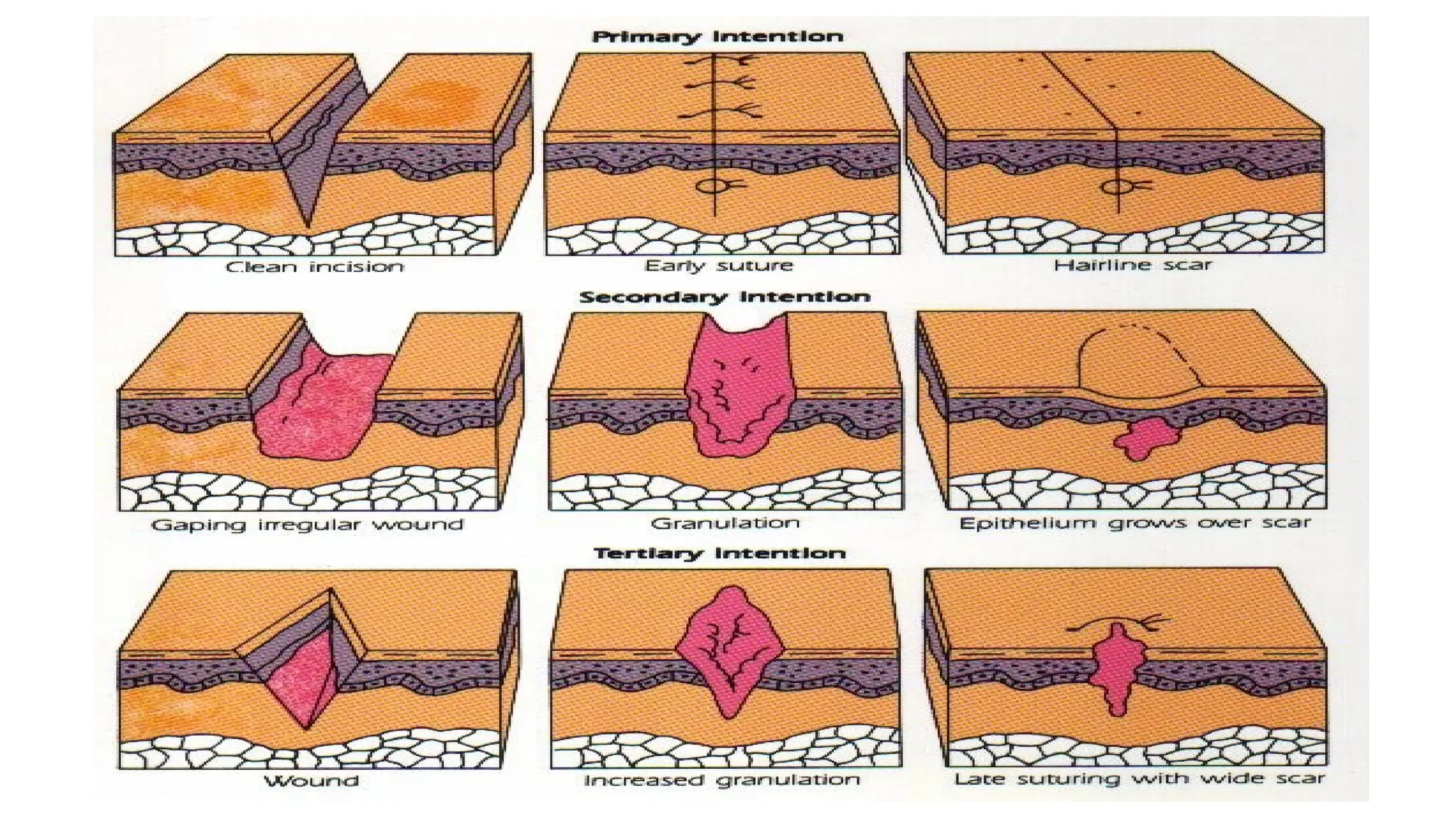 wound ; cause ,classification , healing phases ,pressure ulcer , wound ...