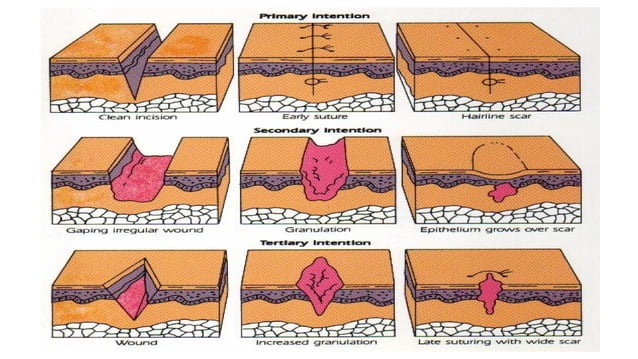 wound ; cause ,classification , healing phases ,pressure ulcer , wound ...