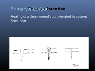 Wounds for Anuradhapura workshop february 2019 | PPT