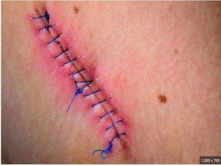 wounds, hemorrahge and shock.pptx for medical students | PPTX