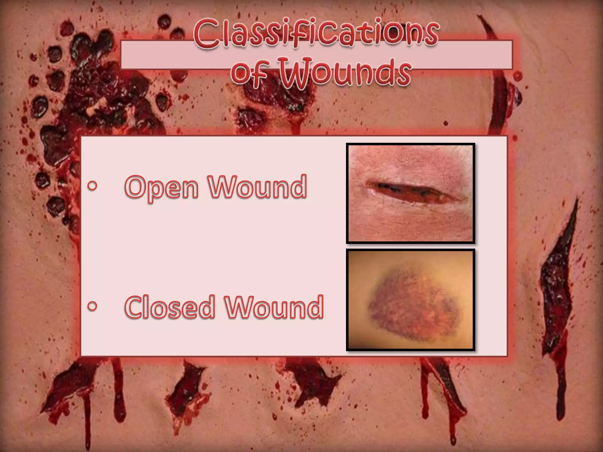 All about Wounds(Types, Classifications, Treatments etc.) | PPTX