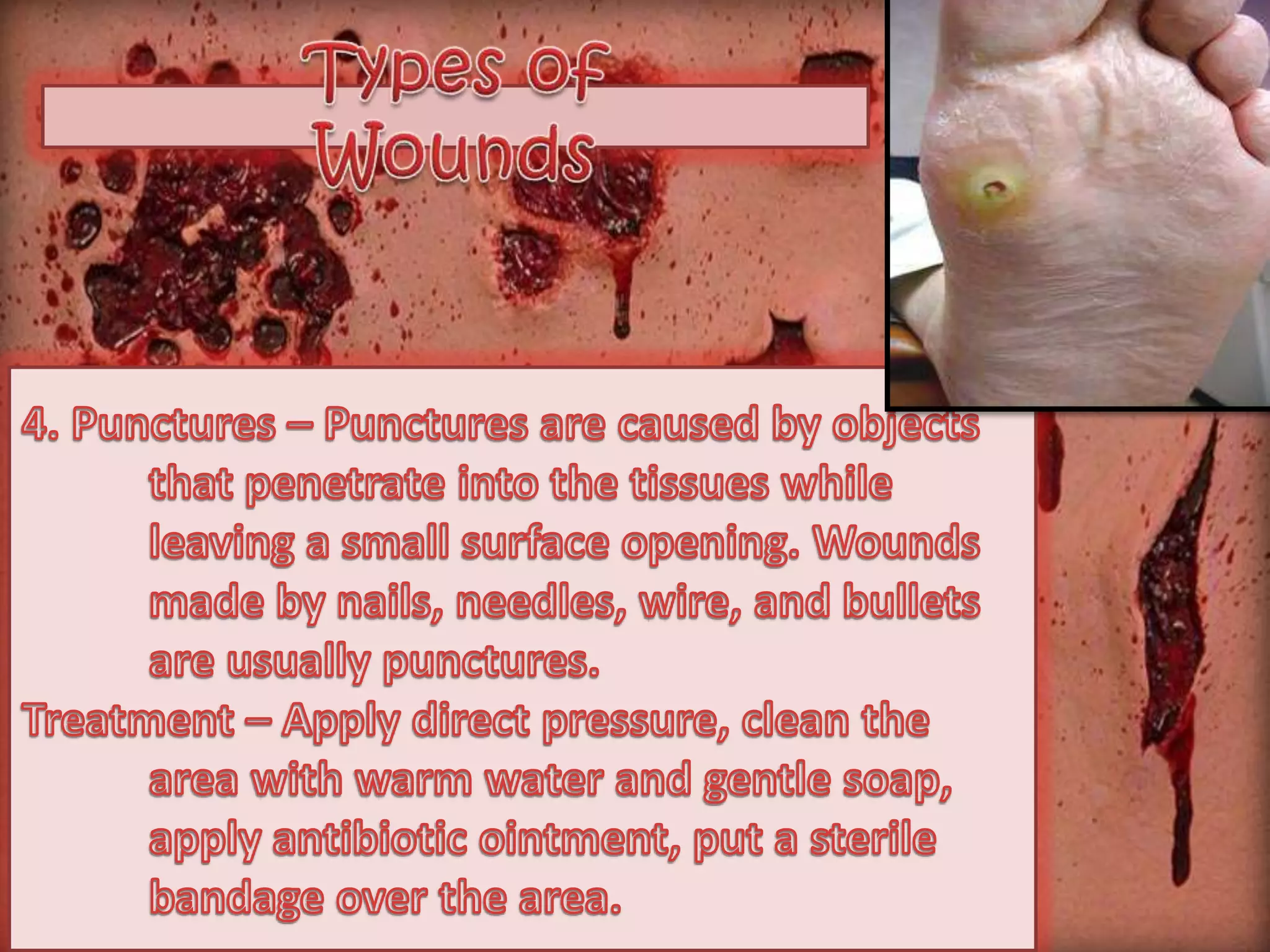 All about Wounds(Types, Classifications, Treatments etc.) | PPTX