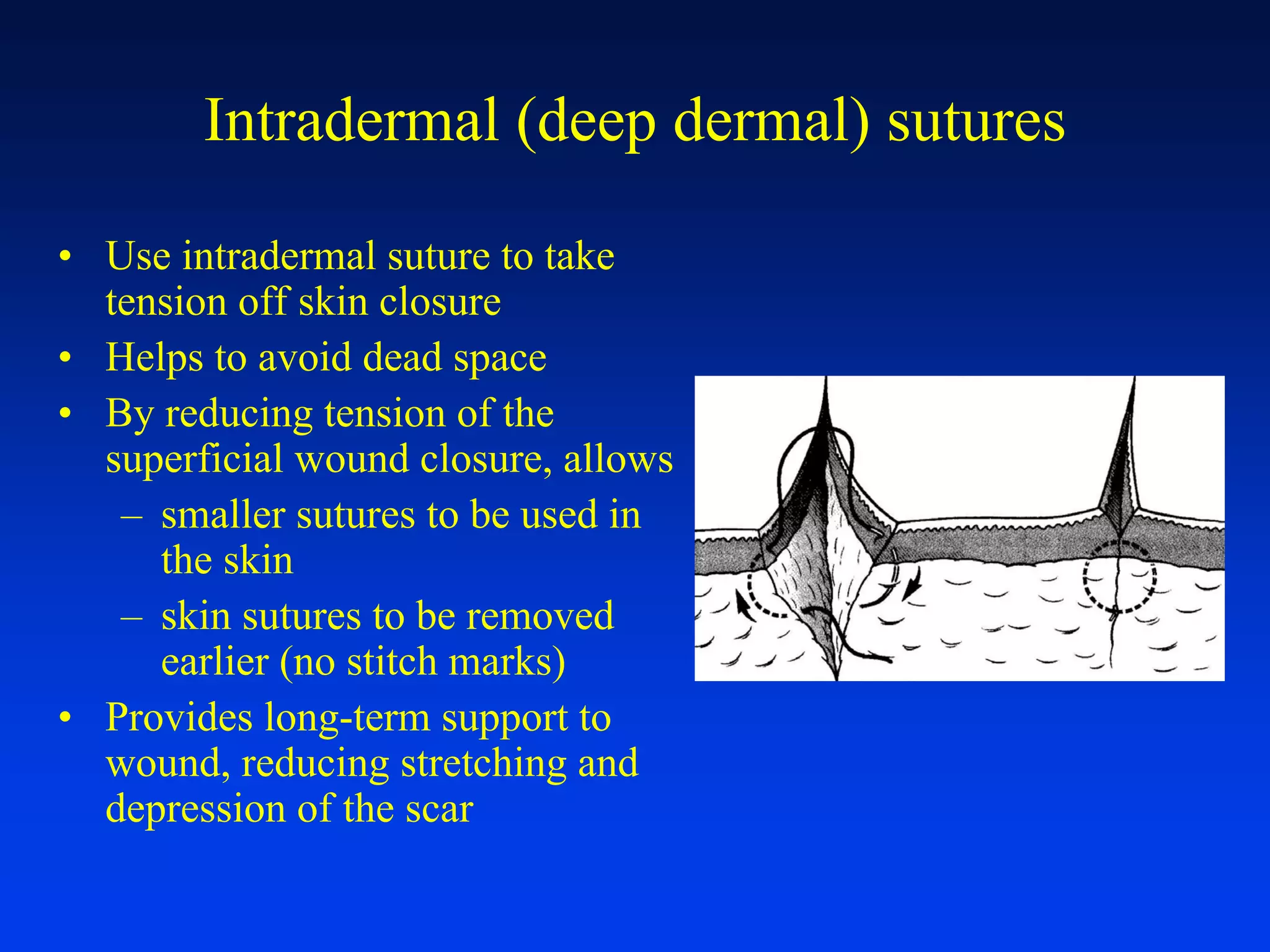 Wound Suturing & Skin Flaps May11 | PDF