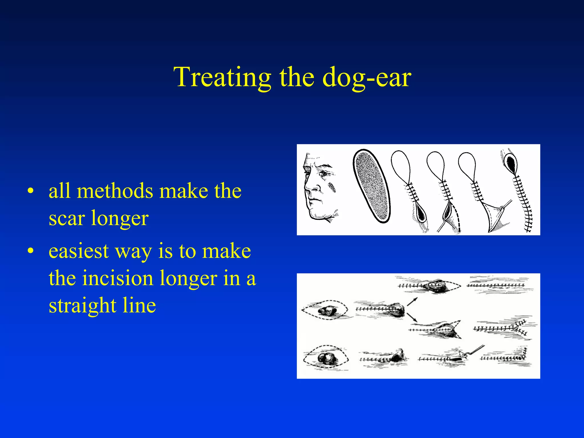 Wound Suturing & Skin Flaps May11 | PDF