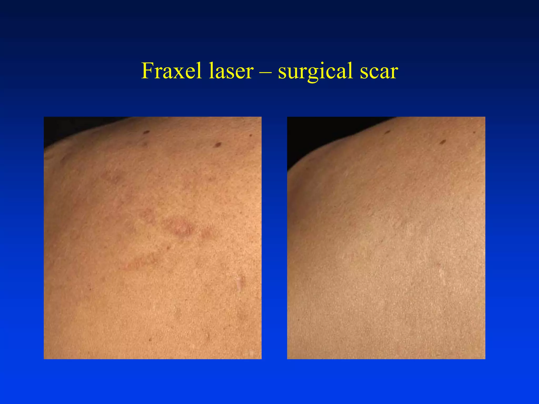 Wound Suturing & Skin Flaps May11 | PDF