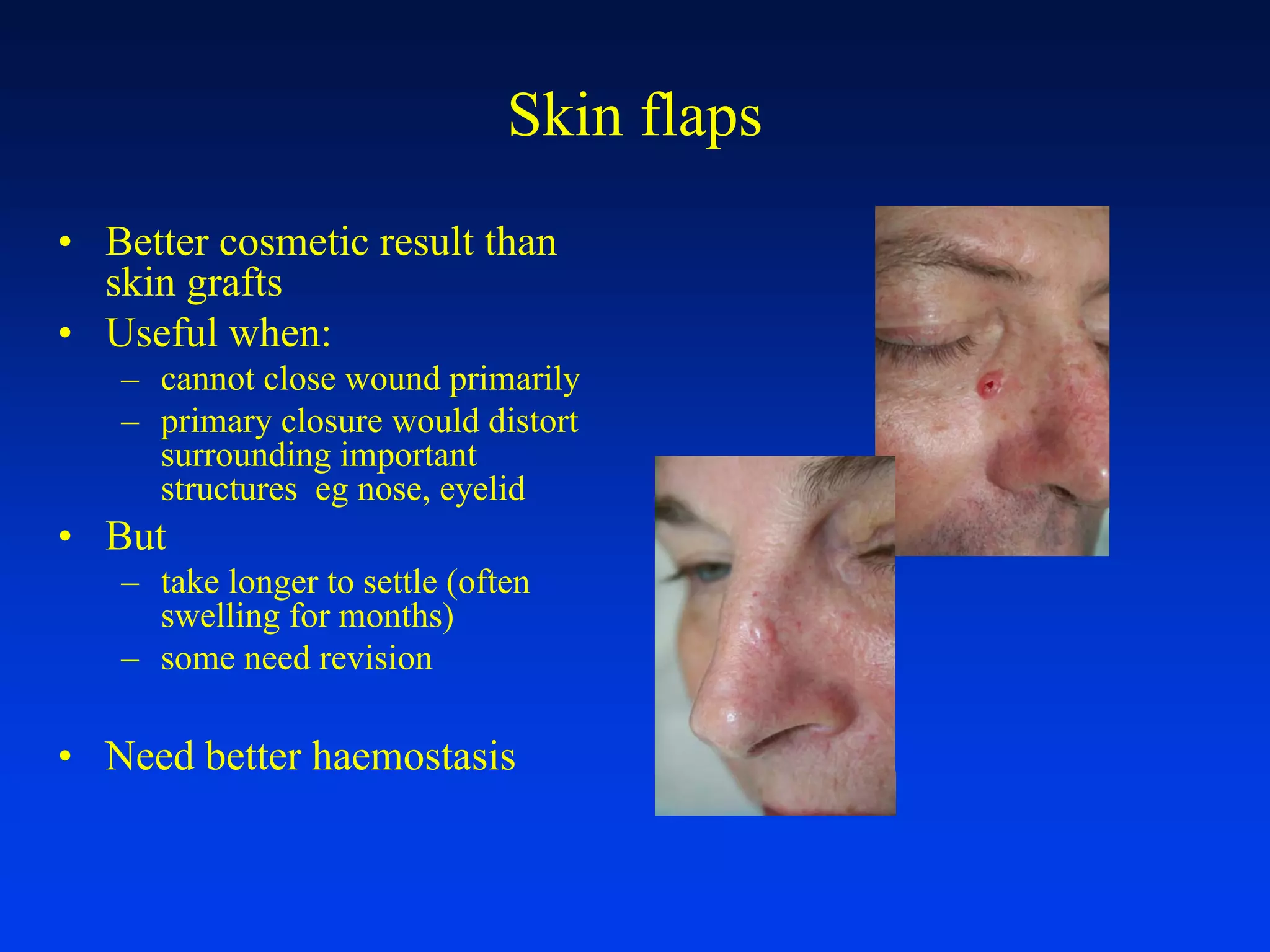 Wound Suturing & Skin Flaps May11 | PDF