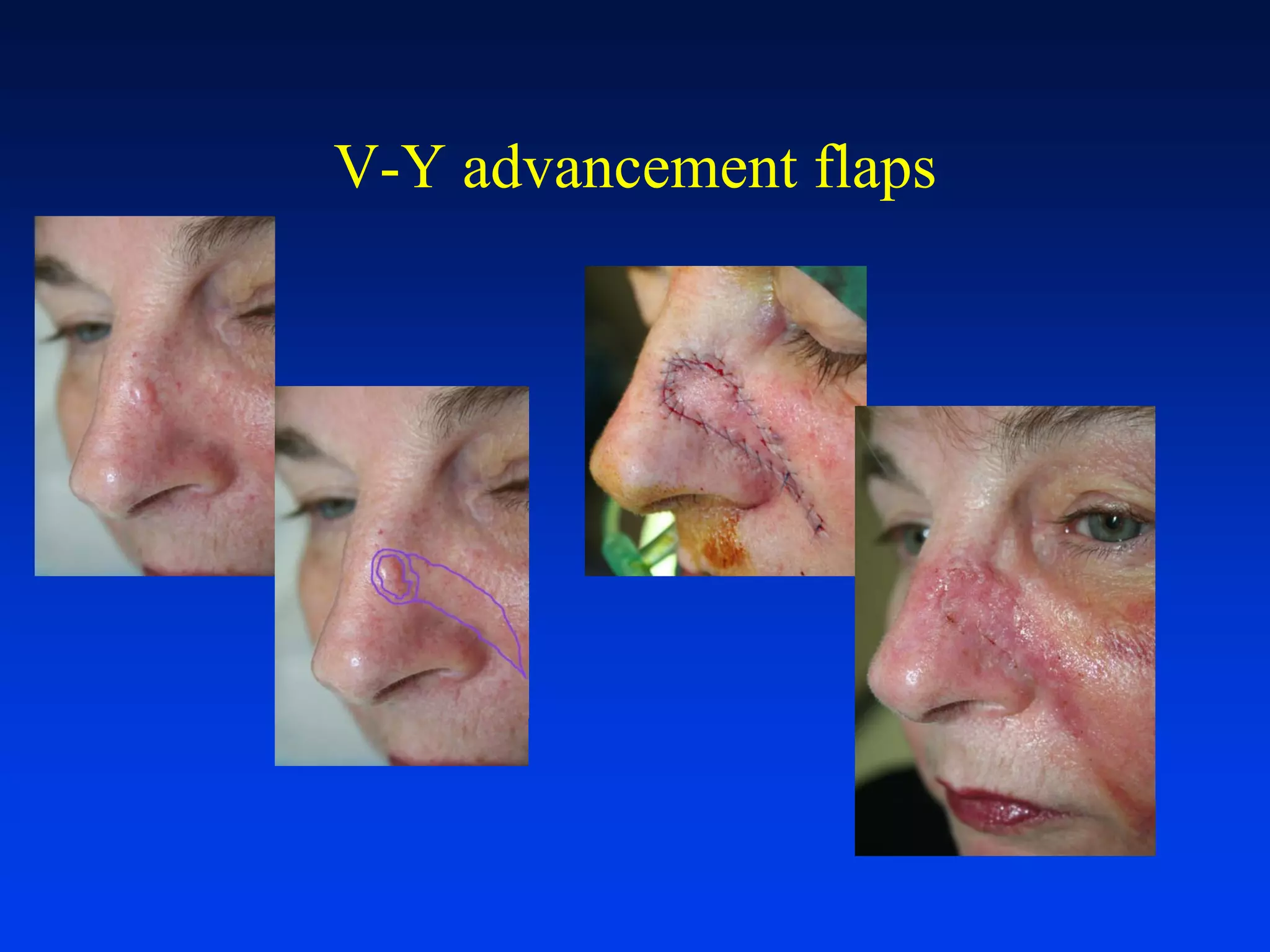 Wound Suturing & Skin Flaps May11 | PDF