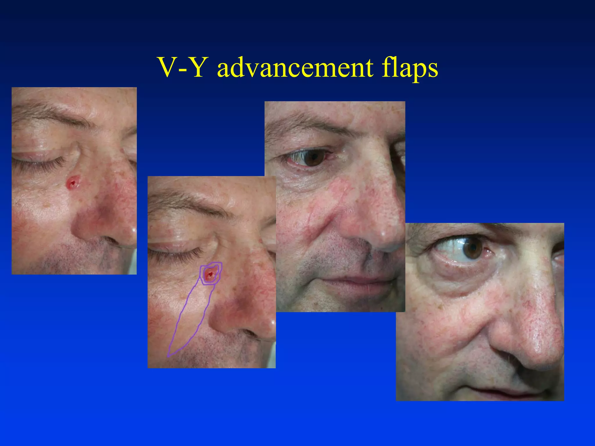 Wound Suturing & Skin Flaps May11 | PDF