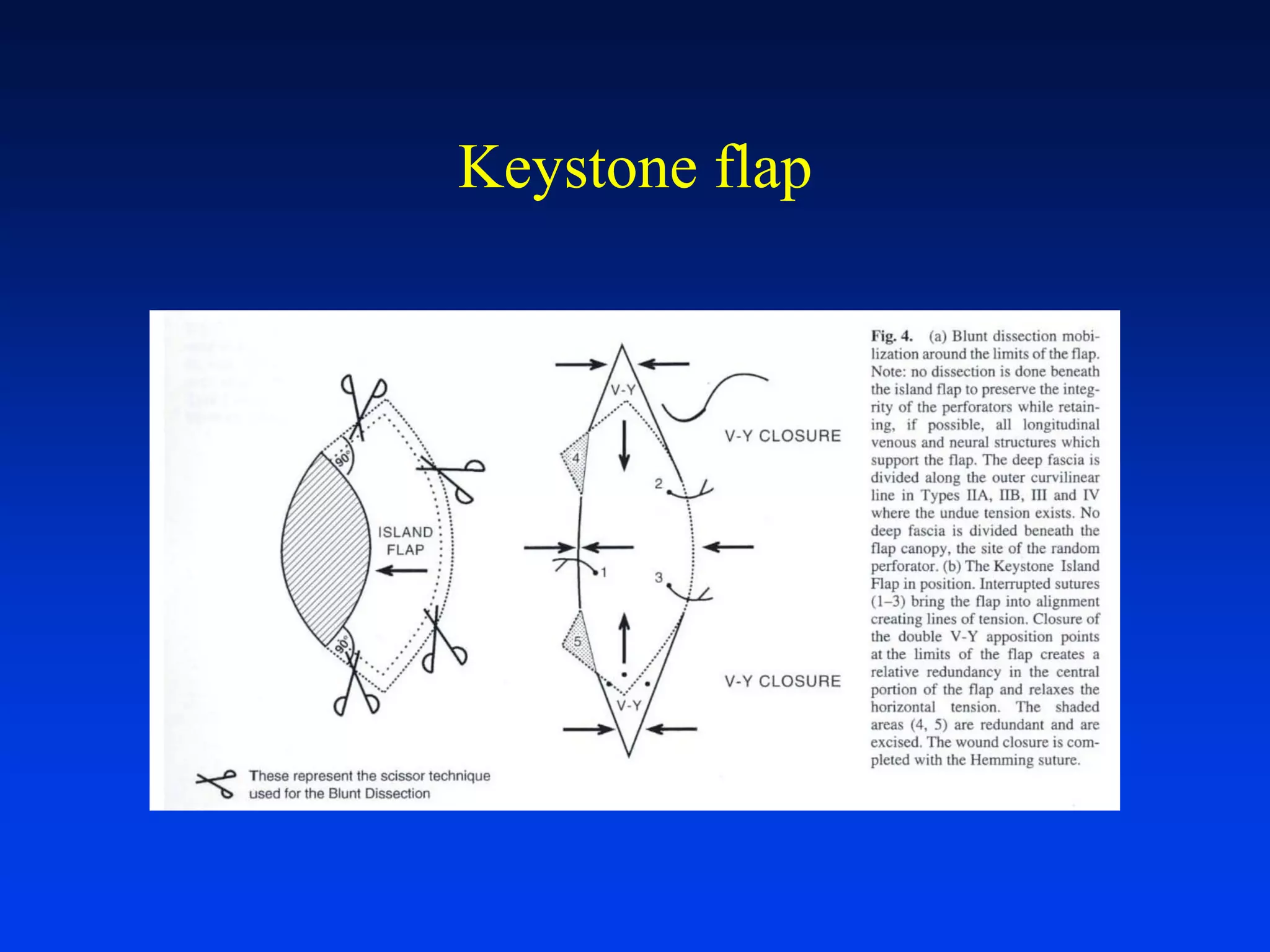 Wound Suturing & Skin Flaps May11 | PPT